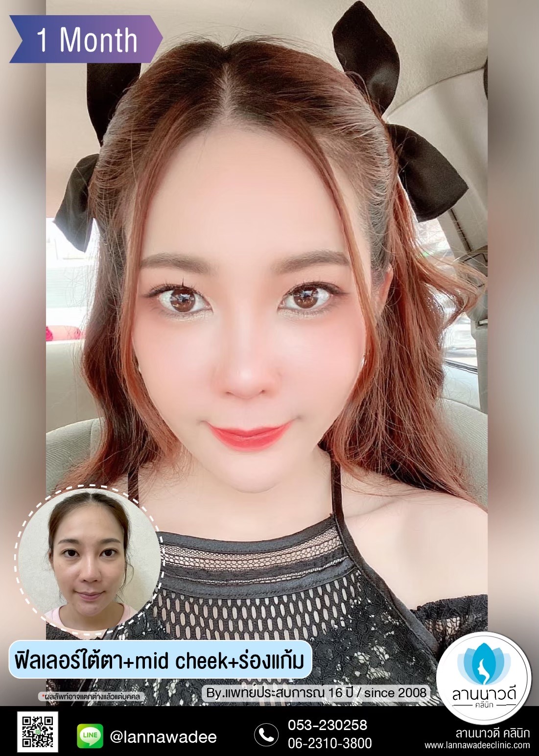 ผ่าถุงใต้ตา โดย ลานนาวดีคลินิก เชียงใหม่